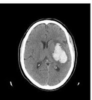 AVC Hemorrágico & Isquêmico ~ Raio X web