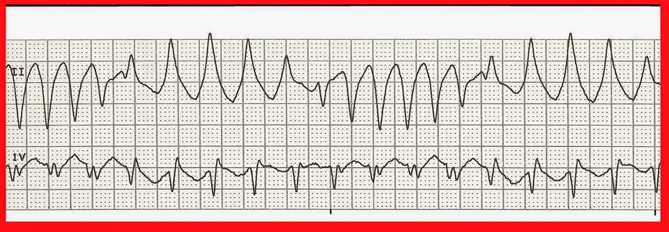 Various Torsades de Pointes