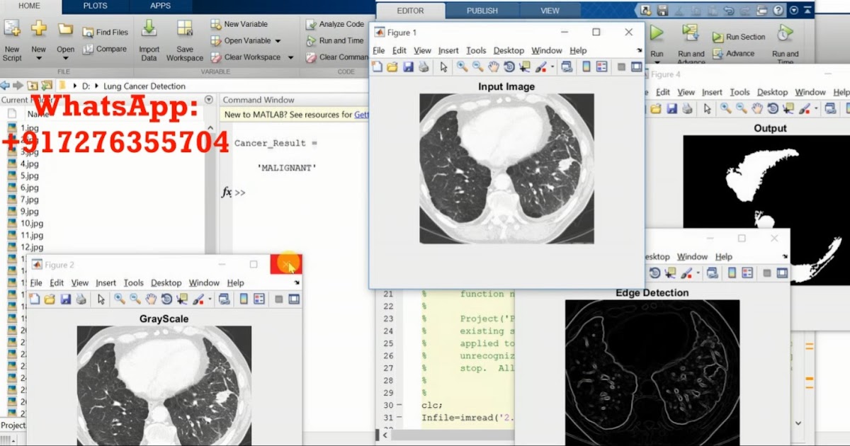 Lung Cancer Detection Using Image Processing Matlab Project Source Code ~ MATLAB PROJECTS