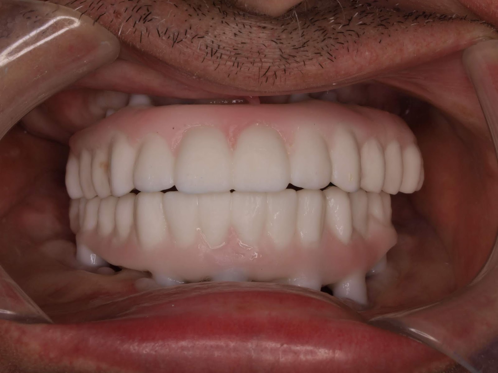 Notas de Odontología: Prótesis híbrida sobre implantes de Zirconio