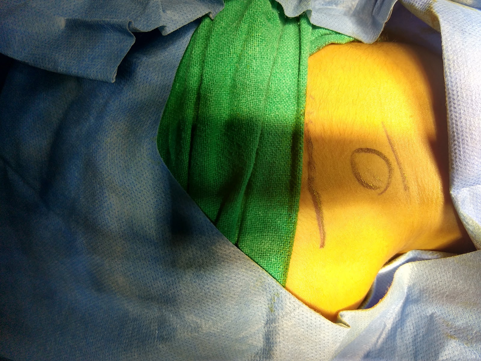 Ent Surgeons Blog Excision Of Sebaceous Cyst In Submandibular Area Of Neck Through Proximal