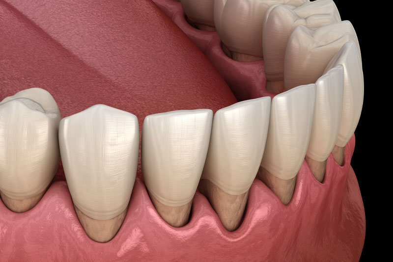 Is It Normal to Have the Roots of Your Teeth Show?