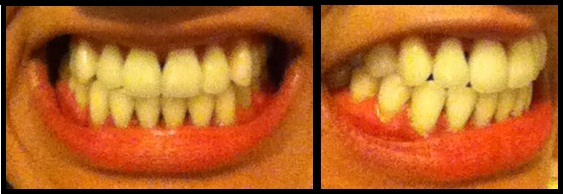 Invisalign For Severe Anterior Open Bite - My Pictures and Story: What ...