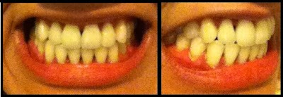 Invisalign For Severe Anterior Open Bite - My Pictures and Story: What ...