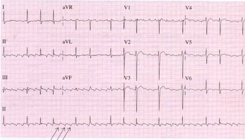 Mengetahui Atrial flutter belajar EKG