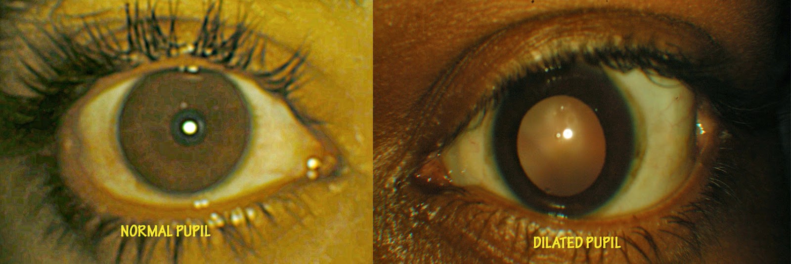 Myopia,Retinal Breaks,Retinal Detachment