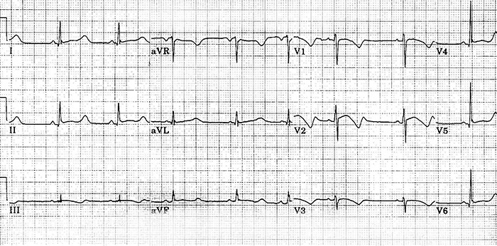 Curso de Lectura Electrocardiografica Veloz: Sindromes