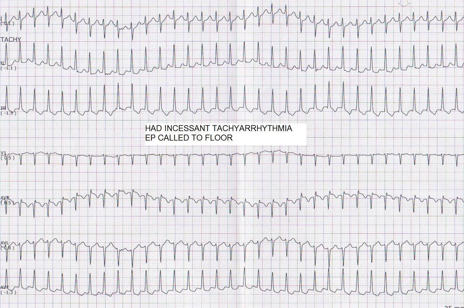 ECG Channel: AV Nodal Reentry Tachycardia
