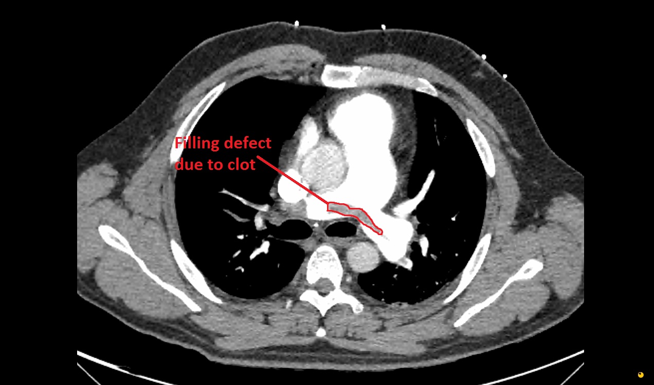 ECG of the Week: ECG of the Week - 8th July 2013 - Interpretation