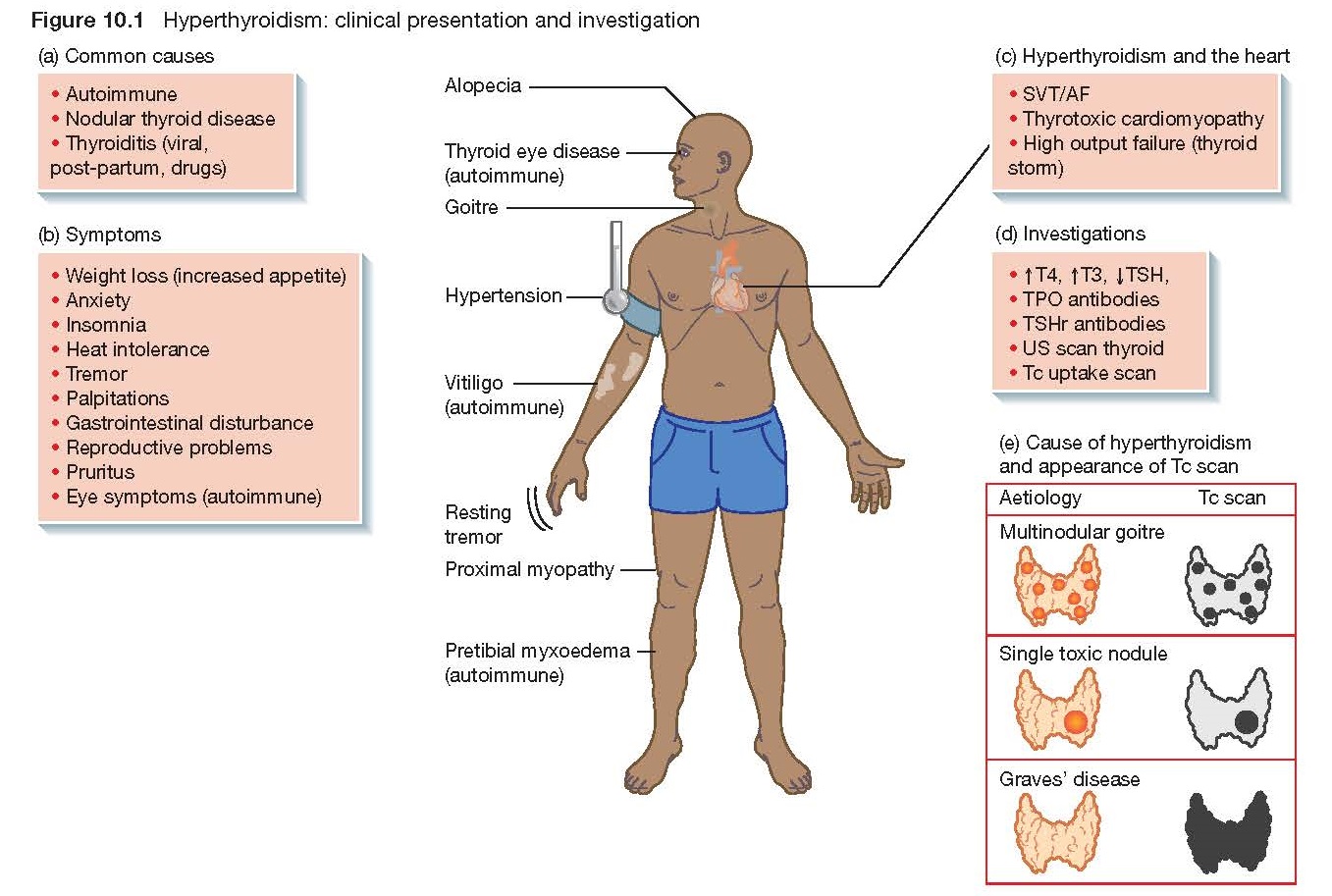 Hyperthyroidism Clinical Presentation and Investigation - pediagenosis Hyperthyroidism Clinical Presentation and Investigation - pediagenosis