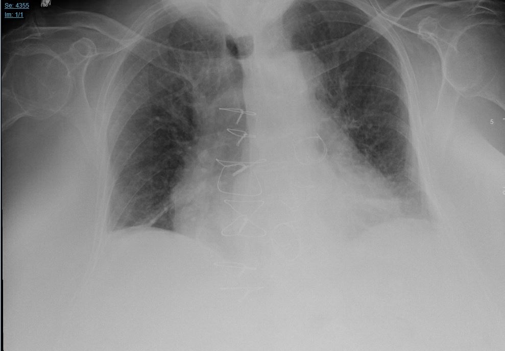 Orion Cardiology, PLLC : Position of Cardiac Devices on CXR