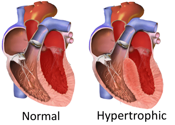 Kardiomiopati Hipertrofik ~ Informasi Kedokteran Dan Kesehatan