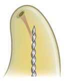 What is Ledge, Zipping, Strip Perforation and Apical Transportation in ...