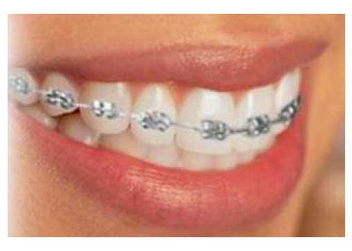 Colores de Brackets y Ligas Bonitas, Para Hombre y Mujer - TIPS!