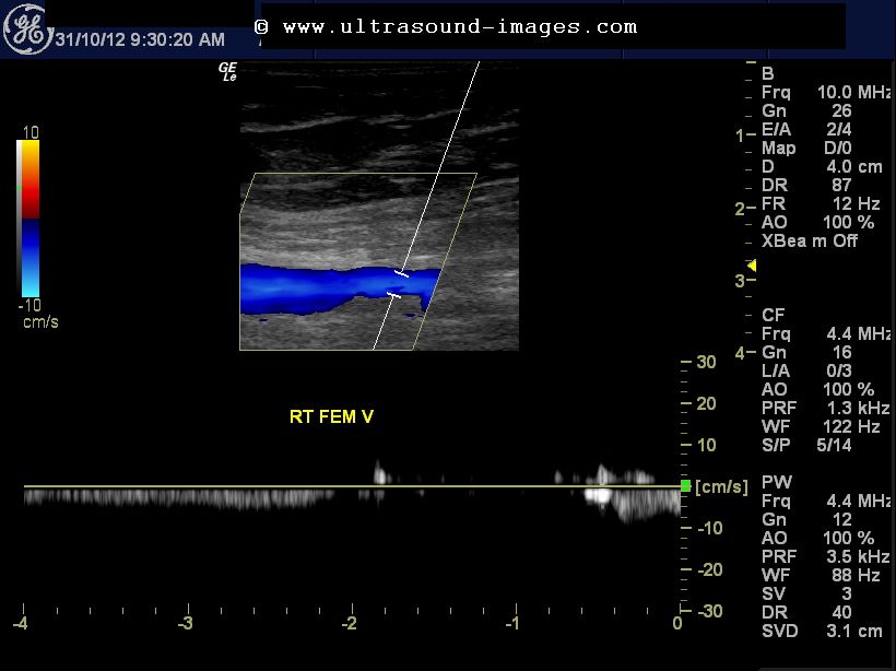 Ultrasound Imaging Deep Vein Thrombosis Before And After Treatment