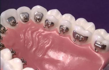 CLINICA MIMA: CLASES DE ORTODONCIA