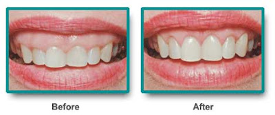 Omni Dental Group: Blog of the Day: Gingivectomy and Gingivoplasty ...