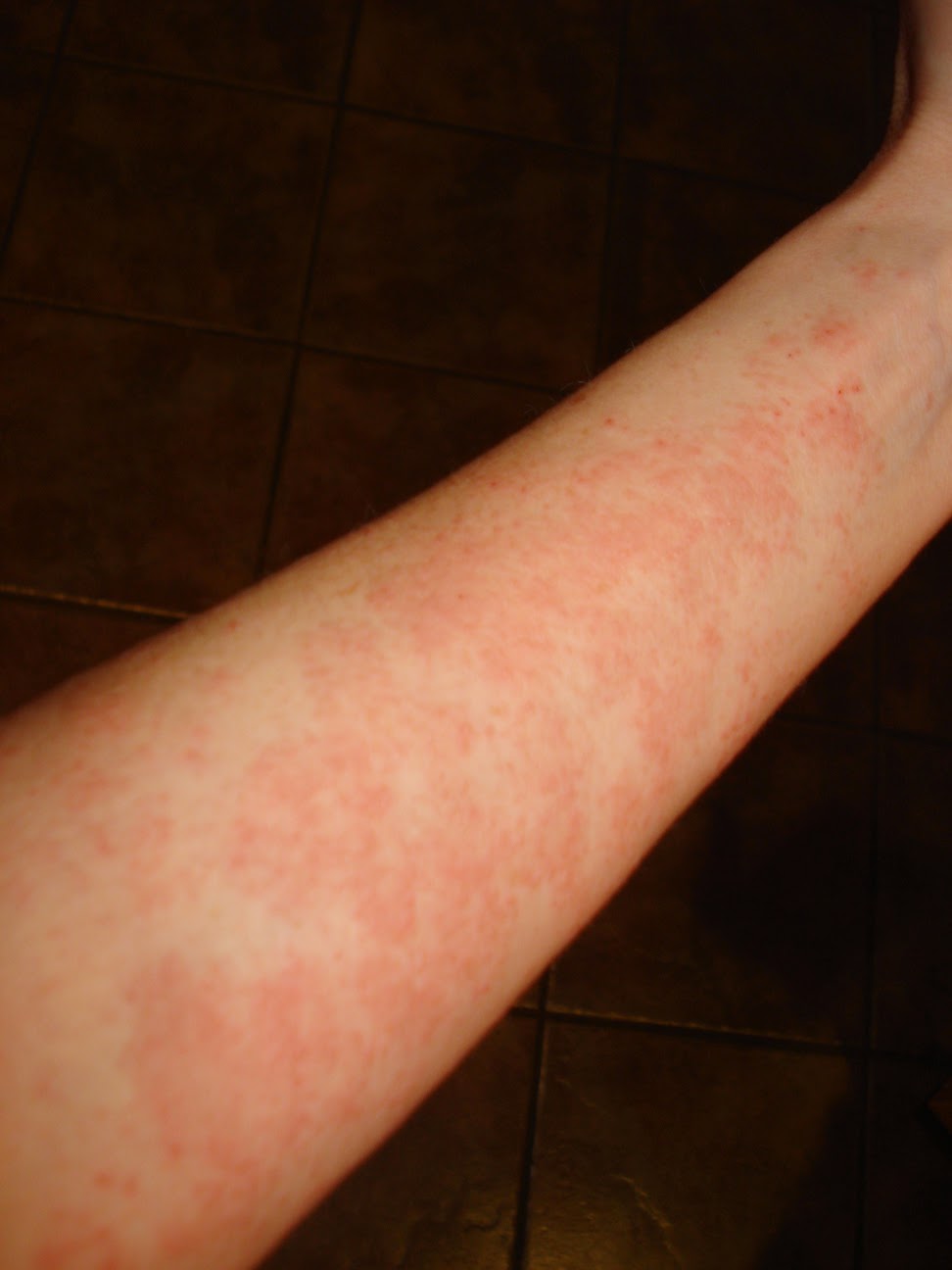 Dyshidrotic Eczema Arms