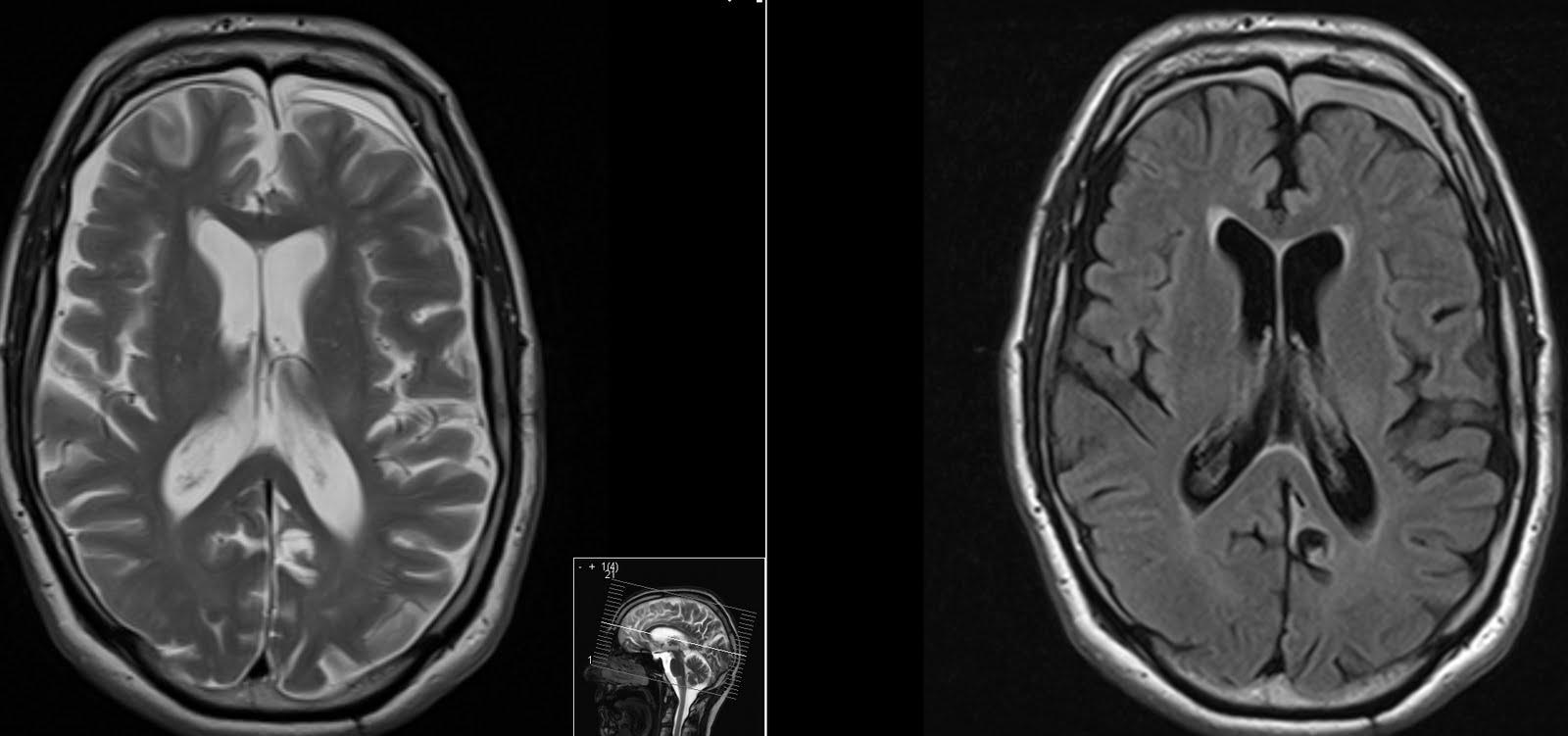 Chronic Subdural Hematomas - MRI
