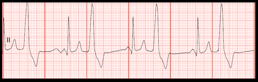 Practice EKG Strips