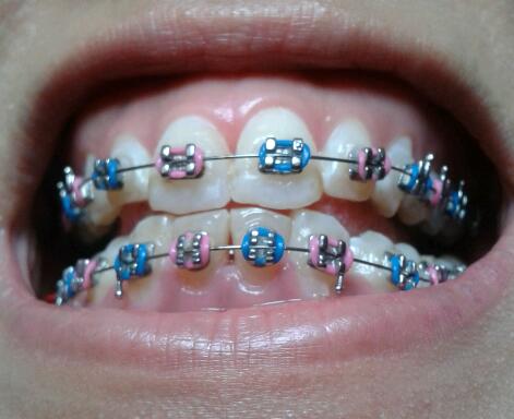 getah braces warna biru - Stephen Randall