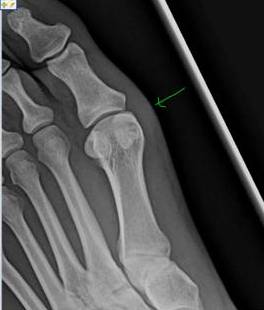 Sesamoid Fracture-Plain Film - Sumer's Radiology Blog