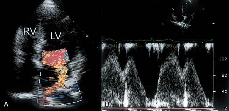 Pulmonary Vein Stenosis on Echocardiography