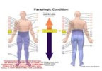 Paraplegia | Expert Homeopathy