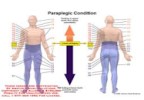 Paraplegia | Expert Homeopathy