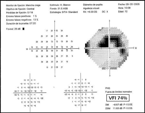 Interpretación Campo visual