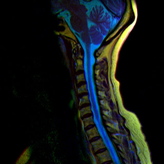 Nevit's blog: Cervical spine Color MRI