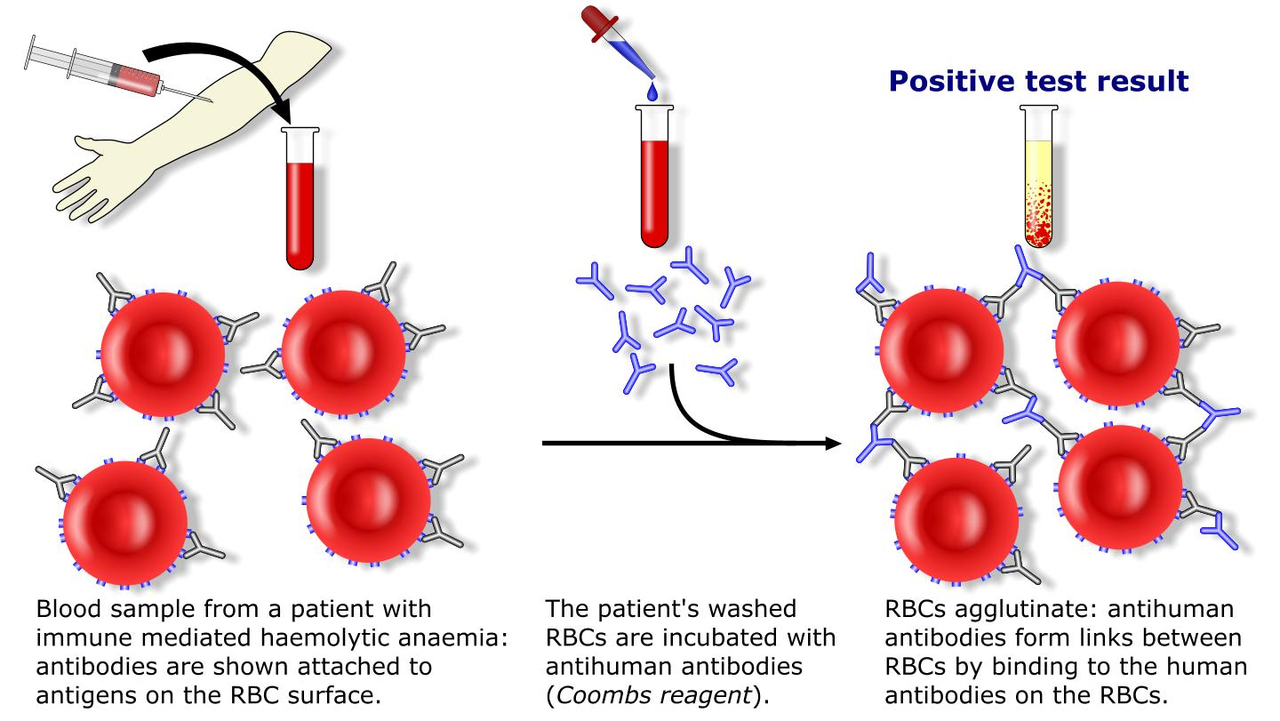 Medical Terms & Сlinical Сases : Coombs test