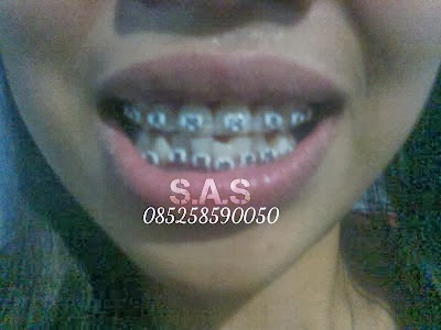 Perbaikan Susunan Gigi Agar Lebih Rapi dan Indah | AHLI GIGI PATI JAWA ...