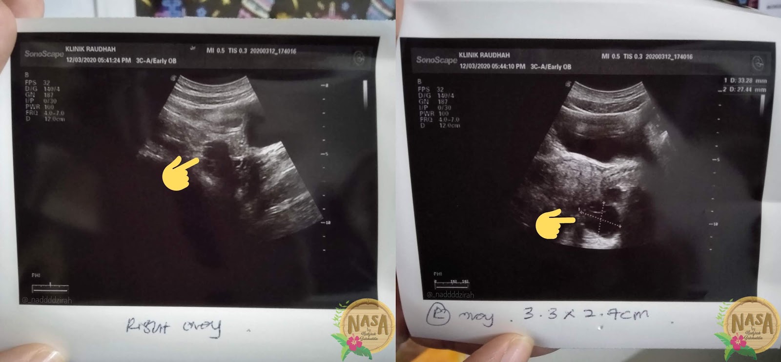 Kisah Aku, Cyst, dan Hormon: Bahagian 1 | NaSa