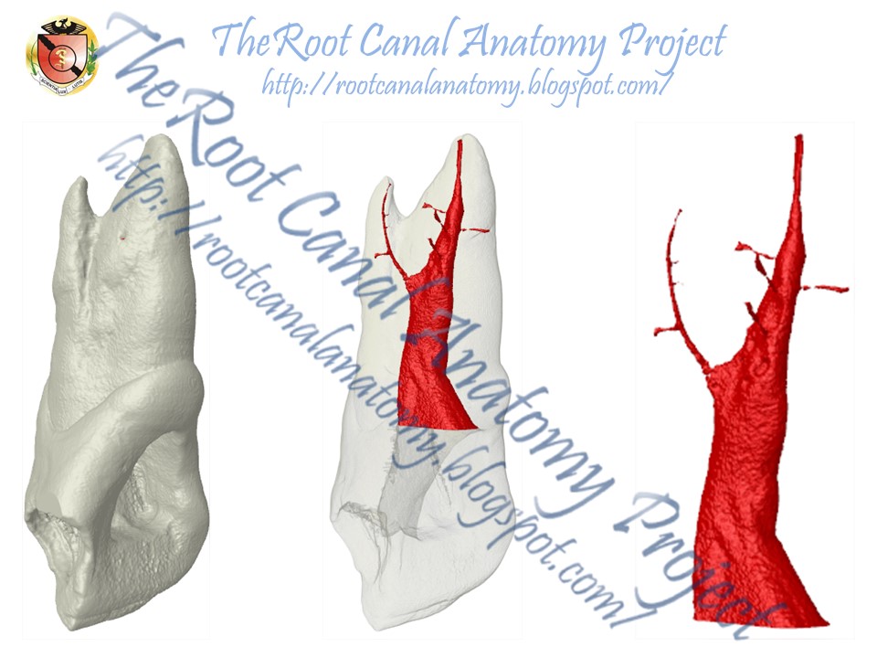 The Root Canal Anatomy Project: Two-Rooted Maxillary Central Incisor