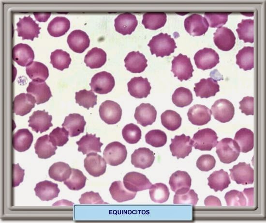 Fichero Hematología : Anormalidades Eritrocitarias