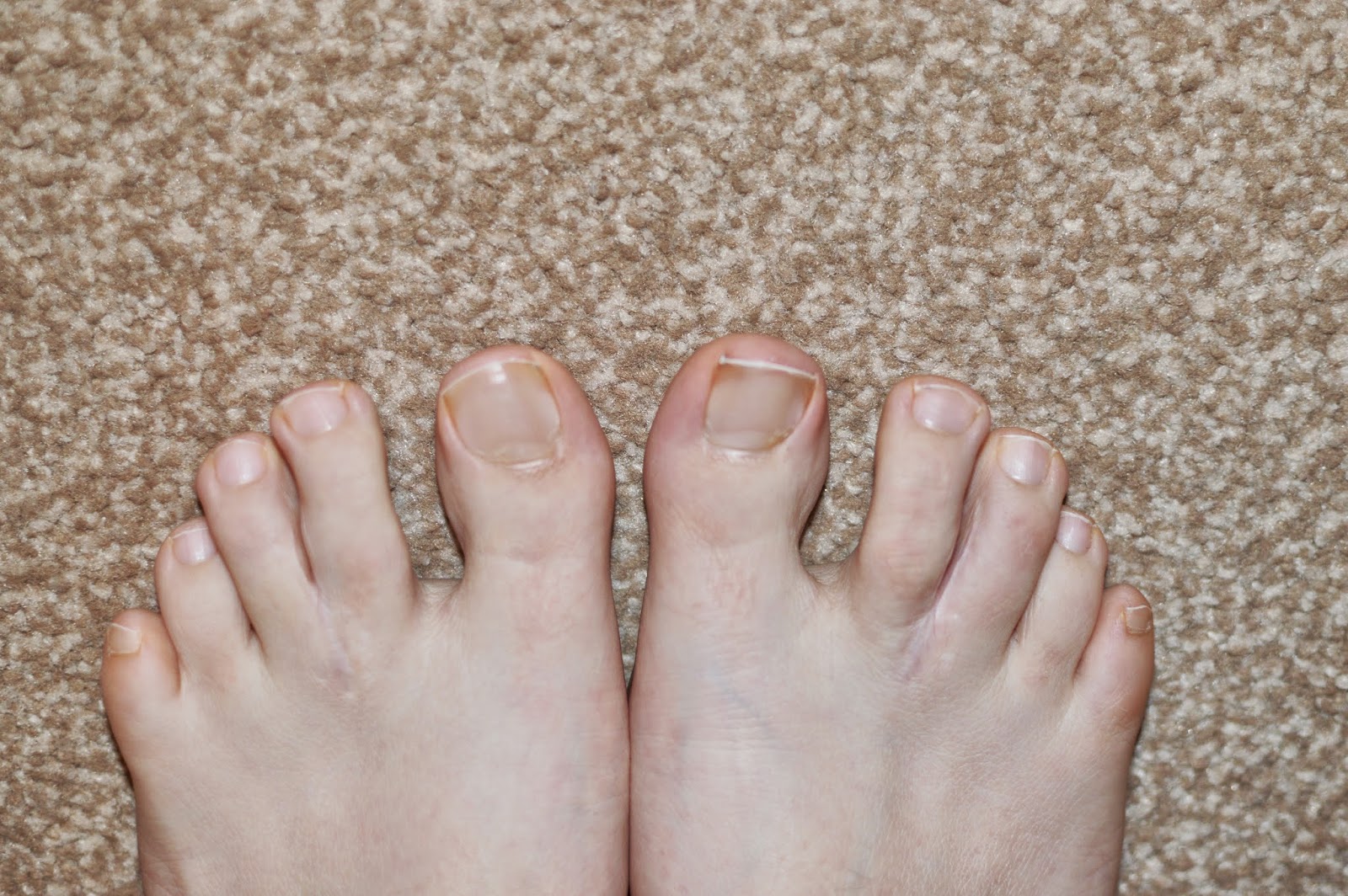 Syndactyly separation