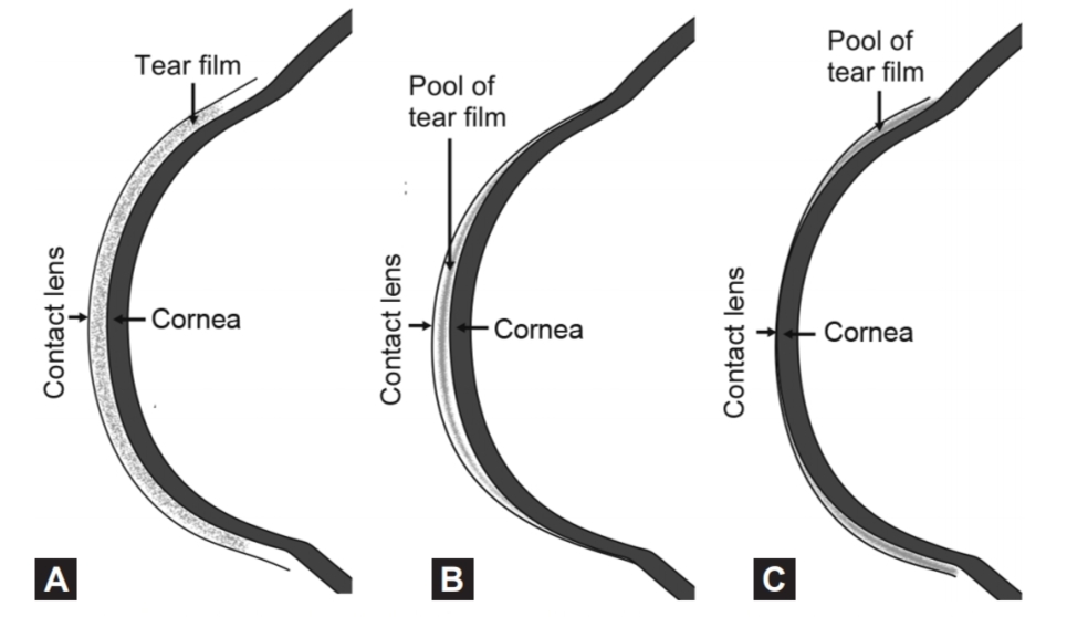 FITTING OF CONTACT LENS AND ITS TYPE