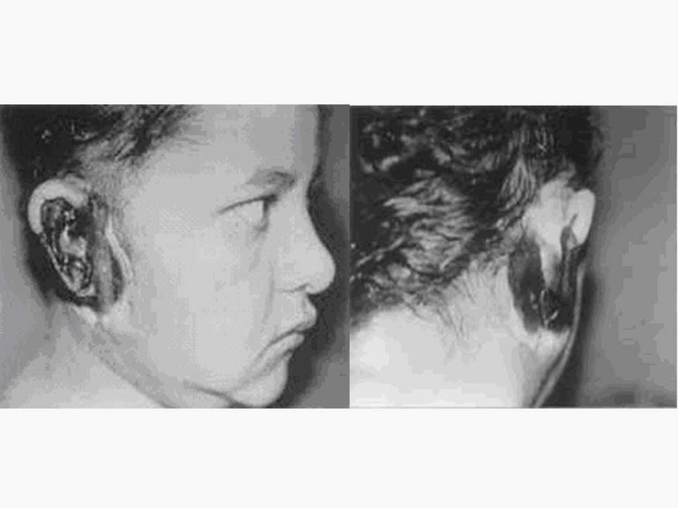 Patologías Oído / Fonoaudiología UBB: 2.1.5 Otitis externa necrotizante ...