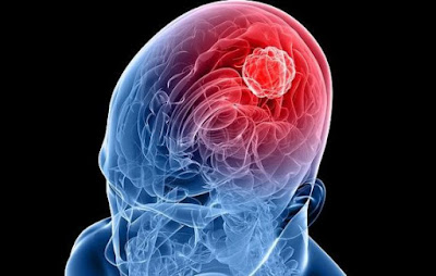The Patient's Outlook with Stage 4 Brain Cancer Survival Rates