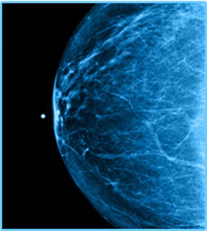 DrDialogue: Sifting Through the Mammogram Muck