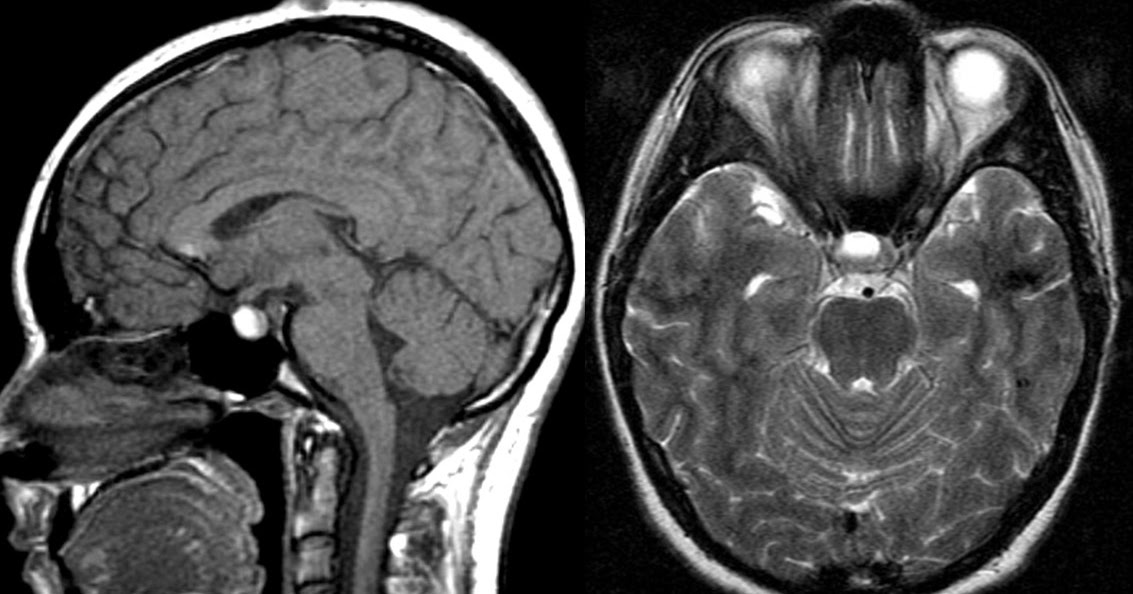 Neuroradiology Cases: Rathke’s Cleft Cyst