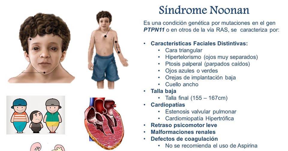 Genética Básica : Pruebas de diagnóstico para el Síndrome de Noonan