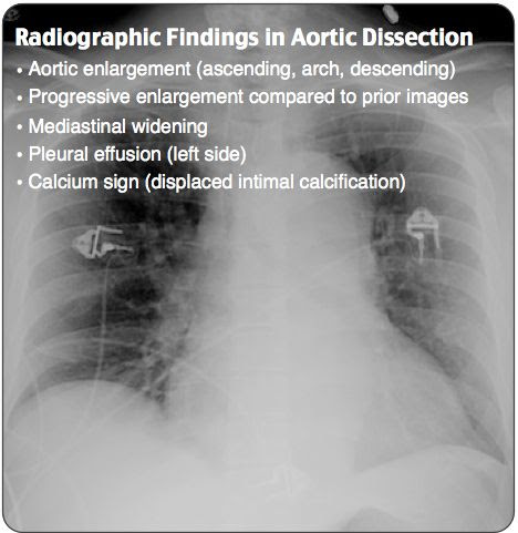 Med4yu: Aortic Dissection