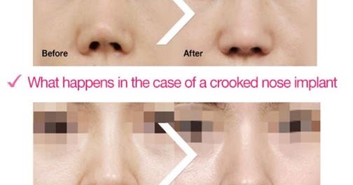 ID Hospital Korea: How to get a natural nose surgery that does not ...
