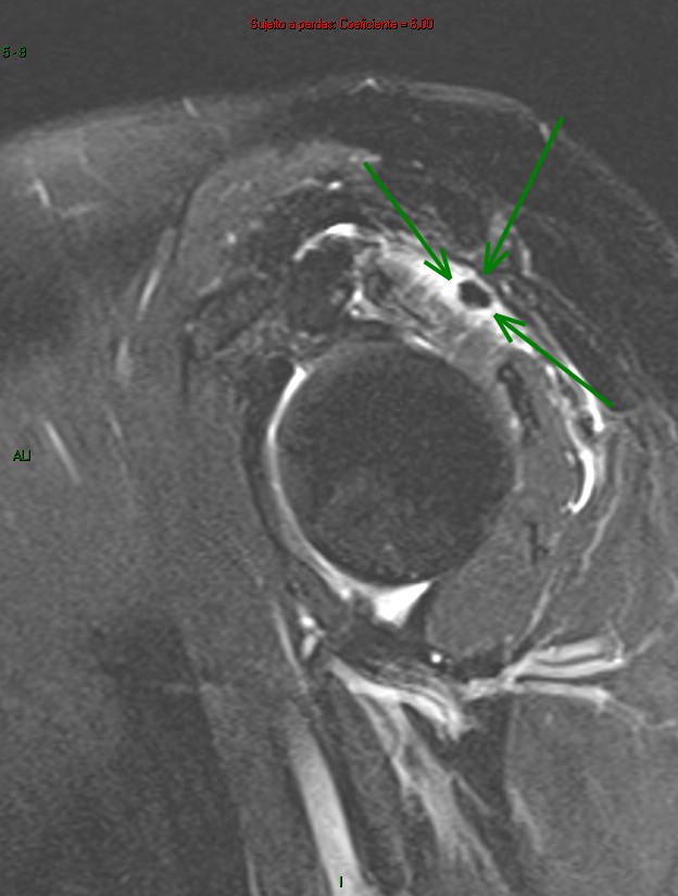 Hydroxyapatite crystal deposition disease (HADD): inflammatory ...