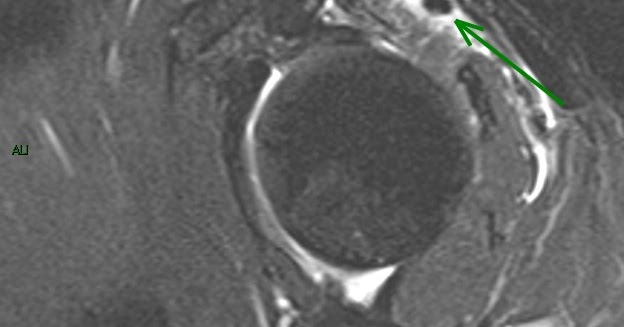 Hydroxyapatite crystal deposition disease (HADD): inflammatory ...