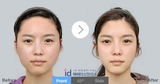 ID Hospital Korea: Have unbalanced face? Your cheekbone might be the ...