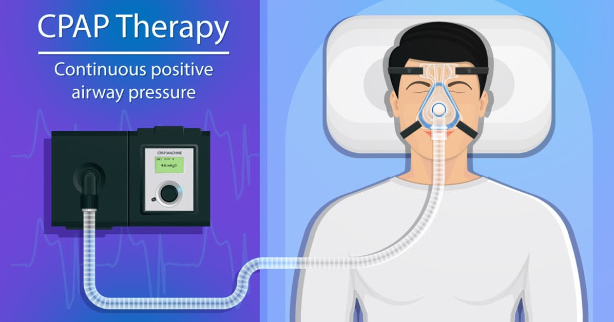 What you should know About Continuous Positive Airway Pressure (CPAP ...
