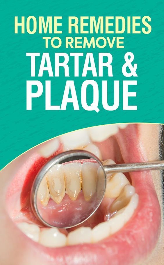 10 Home Remedies To Get Rid Of Tartar And Plaque On Teeth Healthy